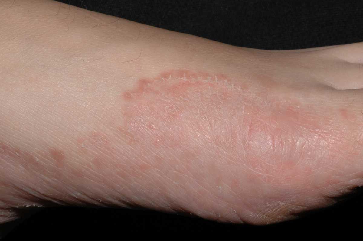 05. MICOSIS CUTÁNEAS