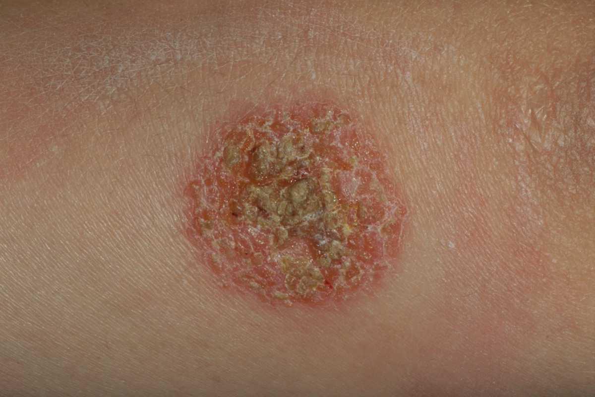 10. DERMATITIS O ECZEMAS