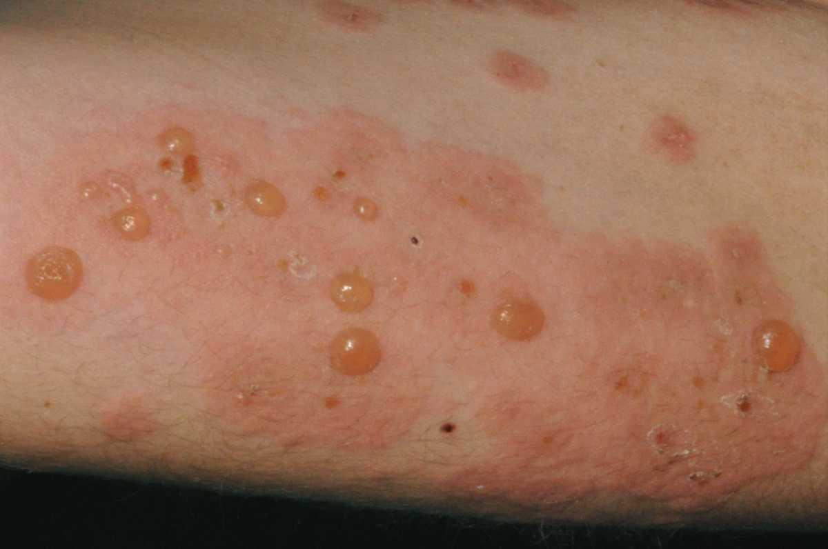 08. DERMATOSIS VESICULOSAS Y AMPOLLOSAS