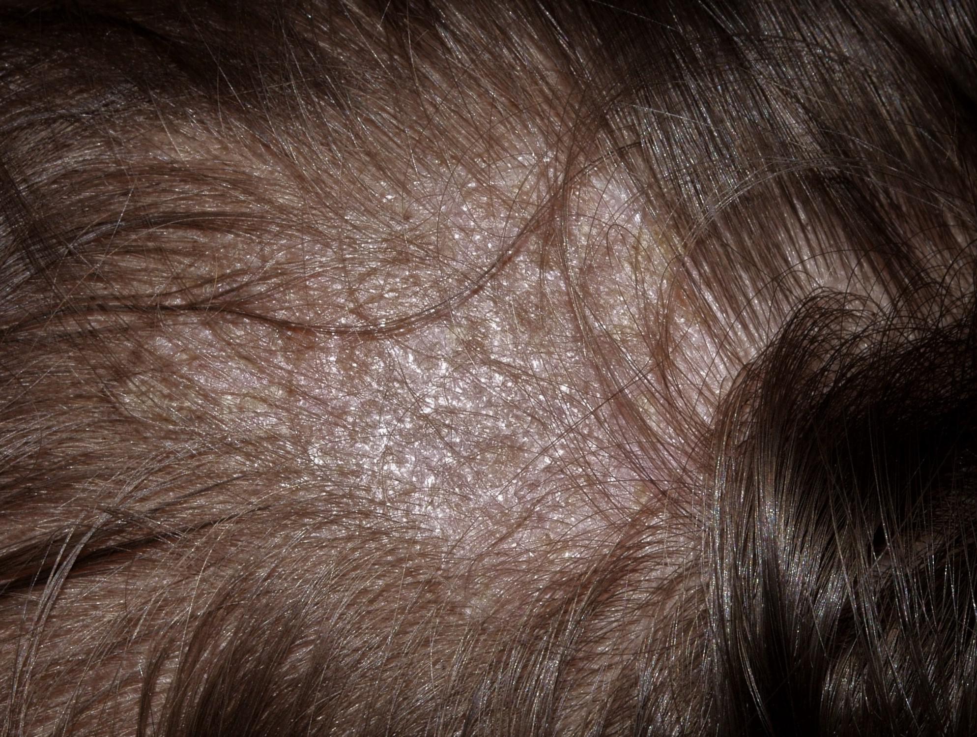 05. MICOSIS CUTÁNEAS