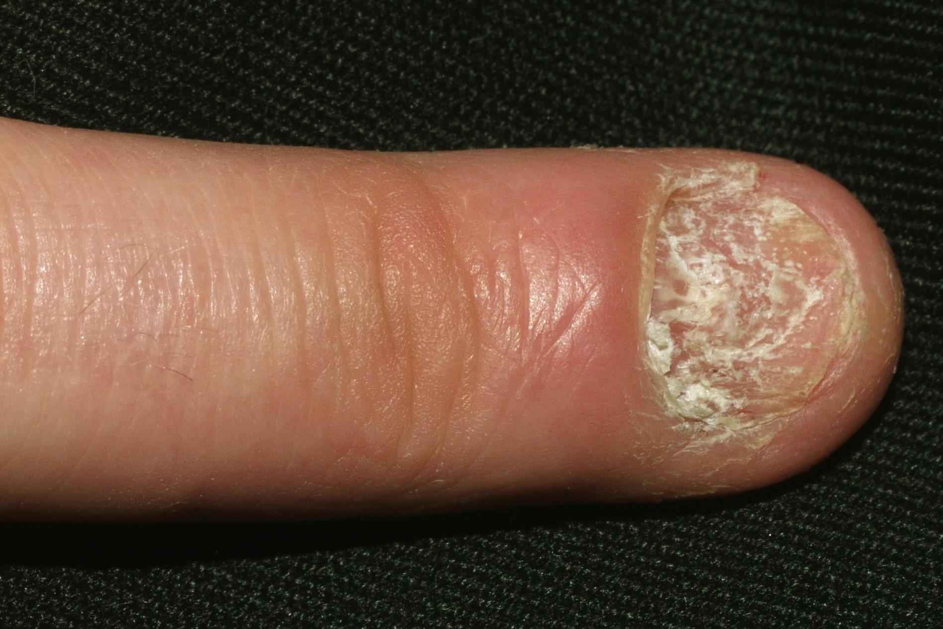 05. MICOSIS CUTÁNEAS